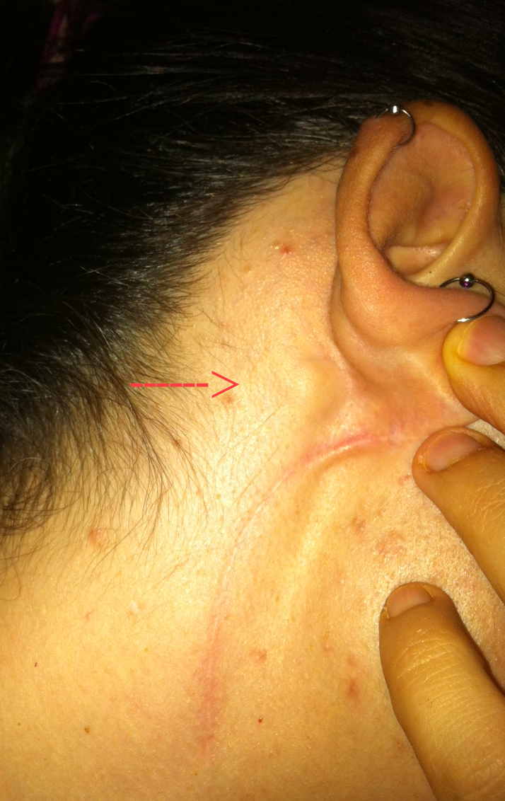 Benign ear cyst or tumor as related to Cancer - Pictures