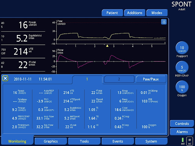 FREMITUS: Obtaining P0.1 on Various Ventilators