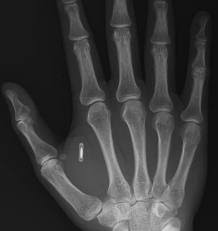 Fascinating Gadgets: Human Microchip