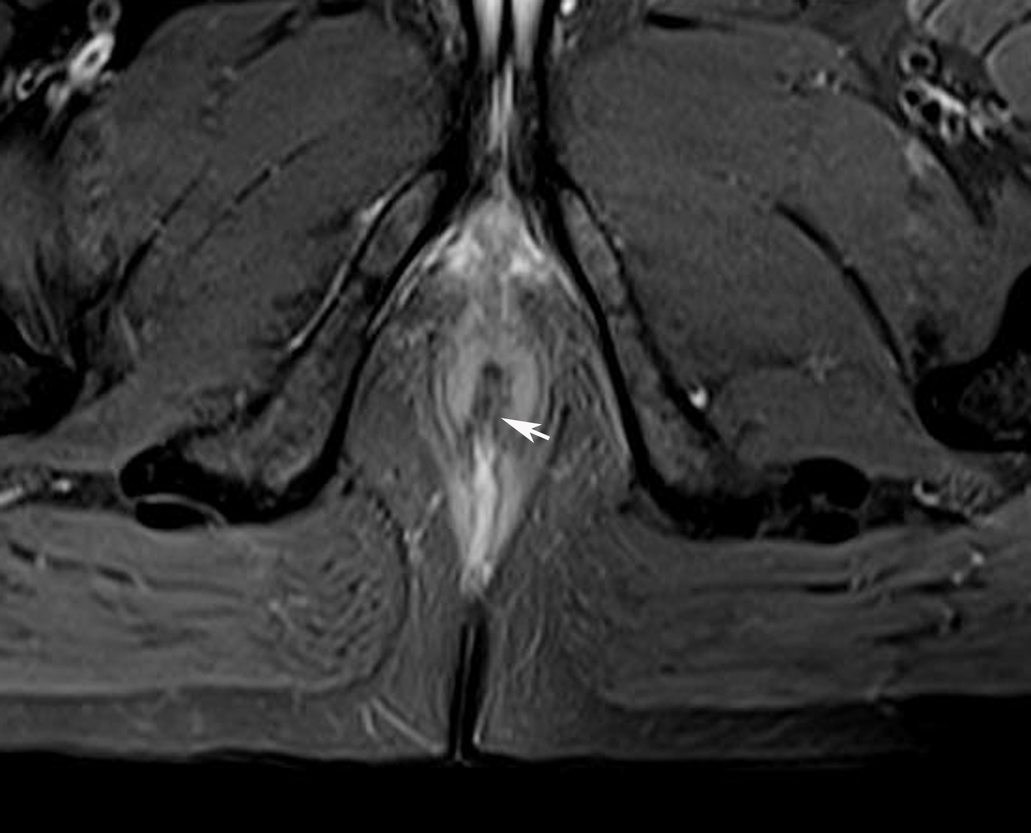 Radiodiagnosis - Imaging is Amazing-Interesting cases: Perianal Fistula ...