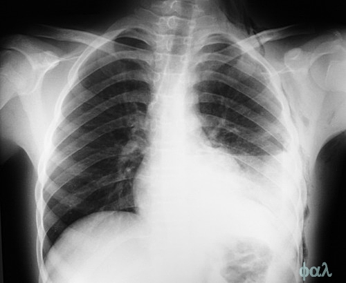 Cuidados UTI: HEMOTÓRAX