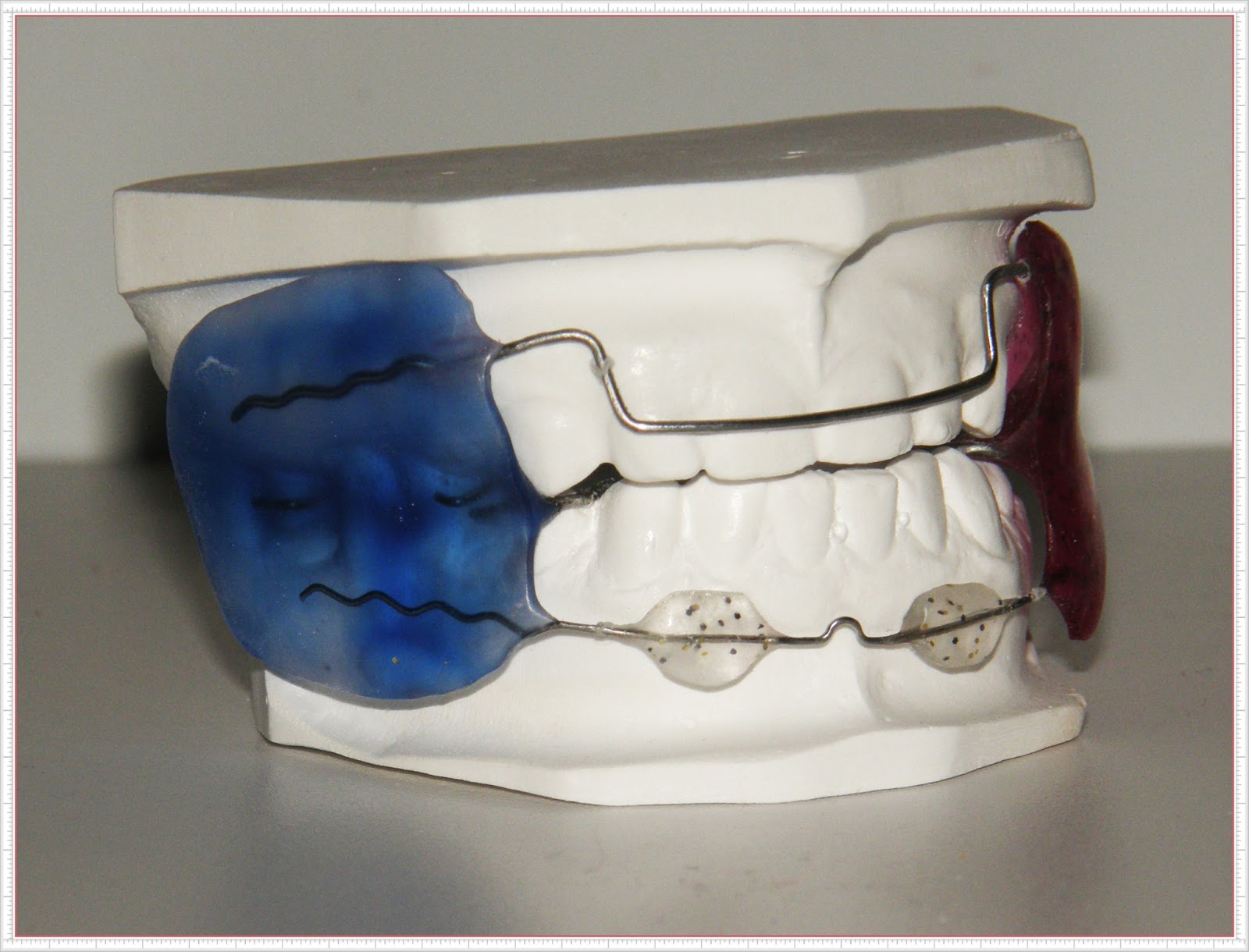 Функционални ортодонтски апарати ~ Медико-техническа ортодонтска ...