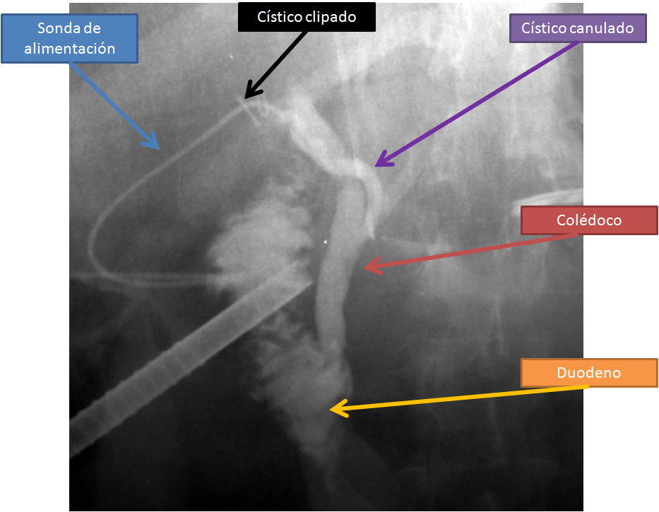 Soluciones Quirúrgicas: ¿Qué es una colangiografía intraoperatoria?