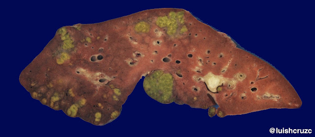 Patología CC: Necrosis hepática submasiva / Submassive hepatic necrosis ...