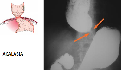 Patología : ESÓFAGO