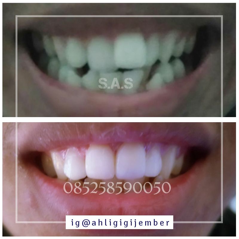 Meratakan Gigi Maju Mundur (Tidak Rapi) Cara Instan dan Cepat Tanpa ...
