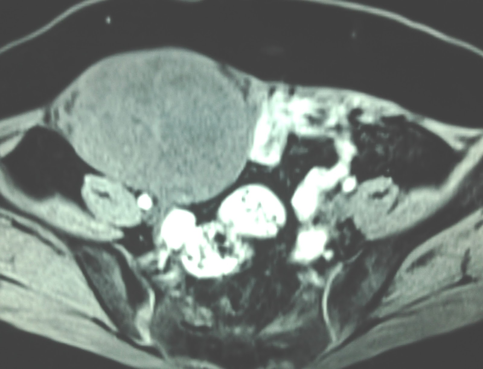 VIETNAMESE MEDIC ULTRASOUND: CASE 361: TUMOR of MUSCLE RECTUS ABDOMINIS ...