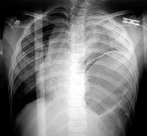 materiales ciclipa II: Traumatismo de torax