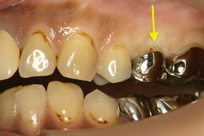 Drなるとのブログ: フルジルコニアクラウンの制作過程 FCZ Crown: Full Contour Zirconia Crown ,KATANA