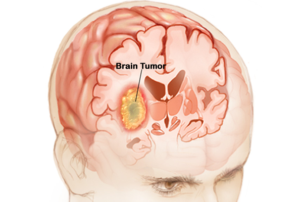 Common signs and symptoms of a brain tumor ~ GEN INFO