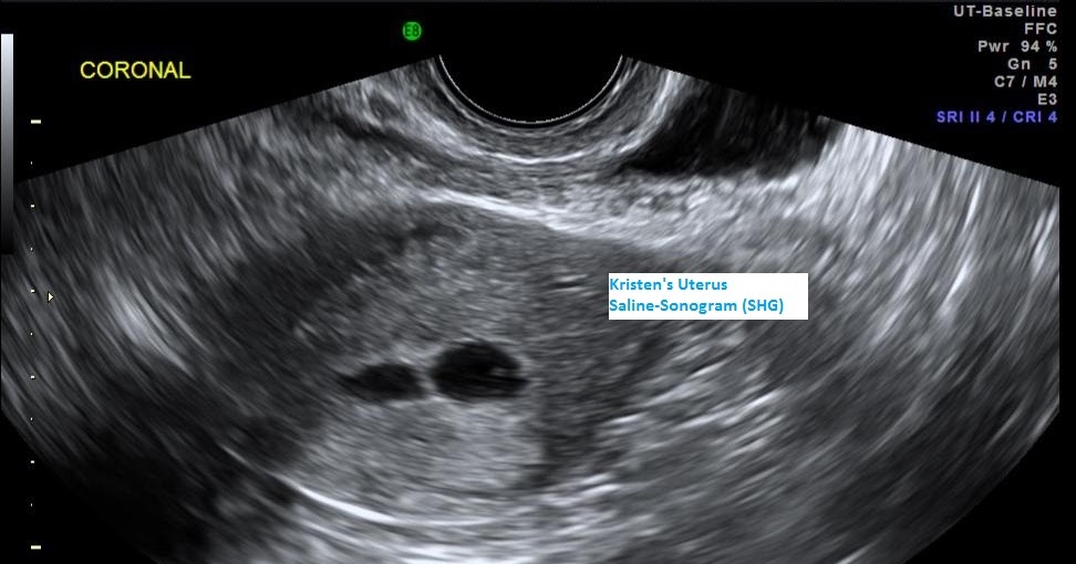 Kristen's Blog: 3. Saline-Sonogram Comparison