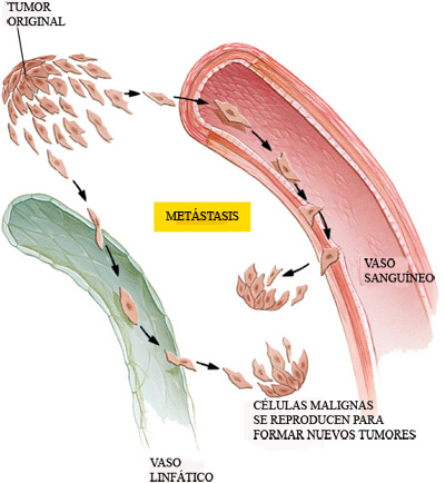 ¿Qué son las metástasis?