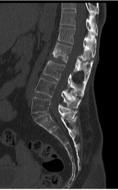 carrot stick fracture and Anderrson lesion | The Third Eye - Radiology site