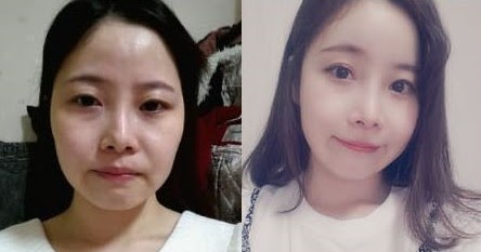 Plastic Surgery in Korea : Meuw’s Plastic Surgery Real Review (Face ...