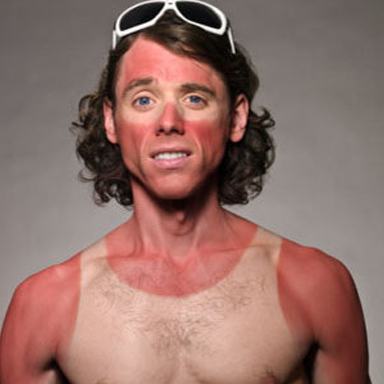 Word for the day:sunburn ~ NATIVE ENGLISH SPAIN