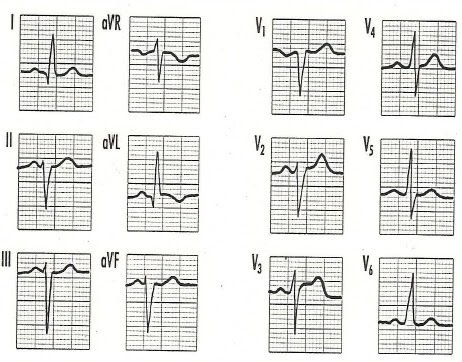 Left Anterior Hemiblock