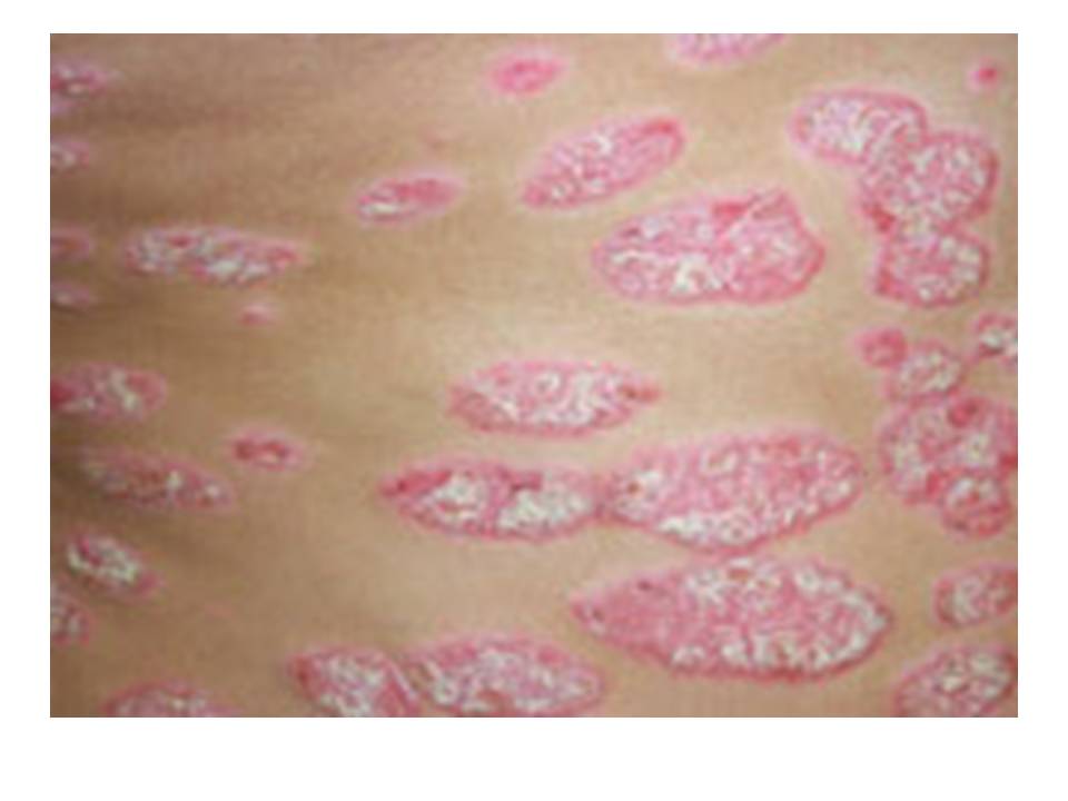 Psoriasis