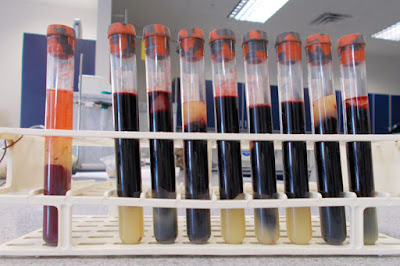 Medical Laboratory and Biomedical Science: Blood Sample Spontaneously ...