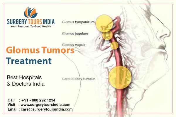 Get the Best and Most Affordable Glomus Tumors Treatment in India with ...