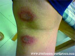 dalam proses belajar lagi: tomcat-Paederus fasciatus