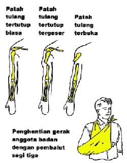 Merawat Tulang Patah (Treating Broken Bones) | HUJAU