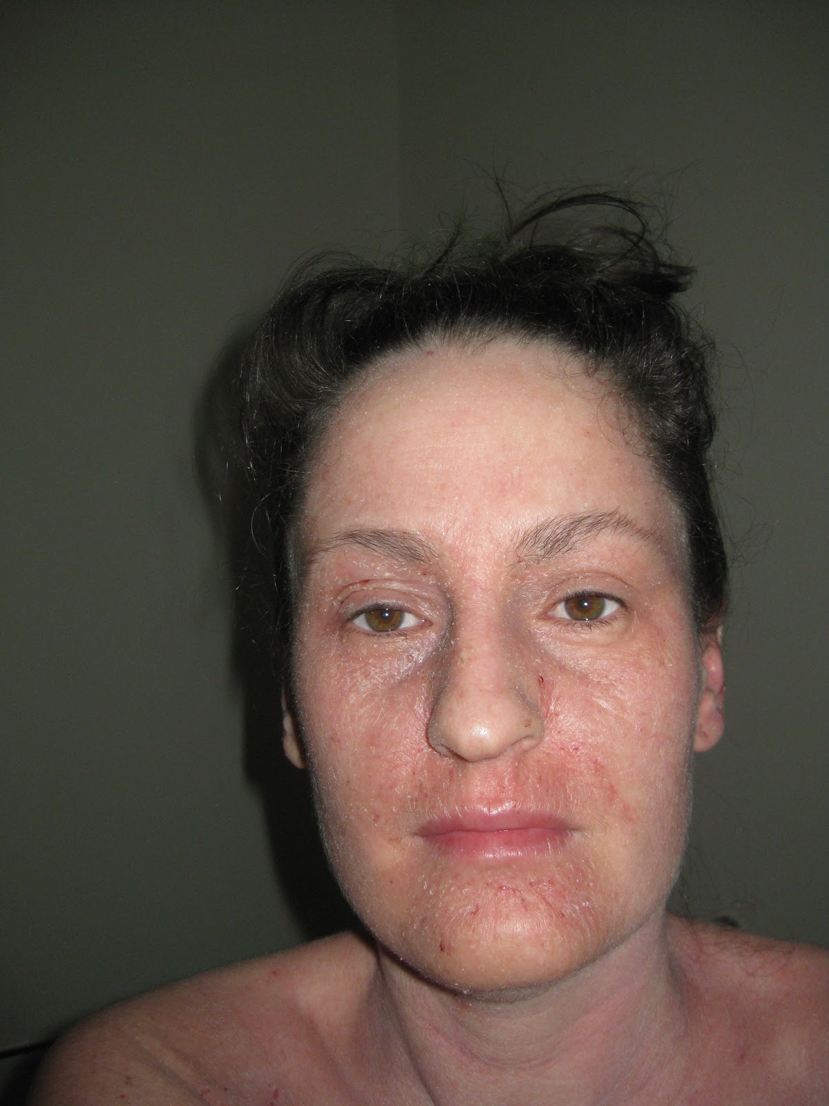 Topical Steroid Withdrawal Journey-Healing Eczema and Red Skin Syndrome ...