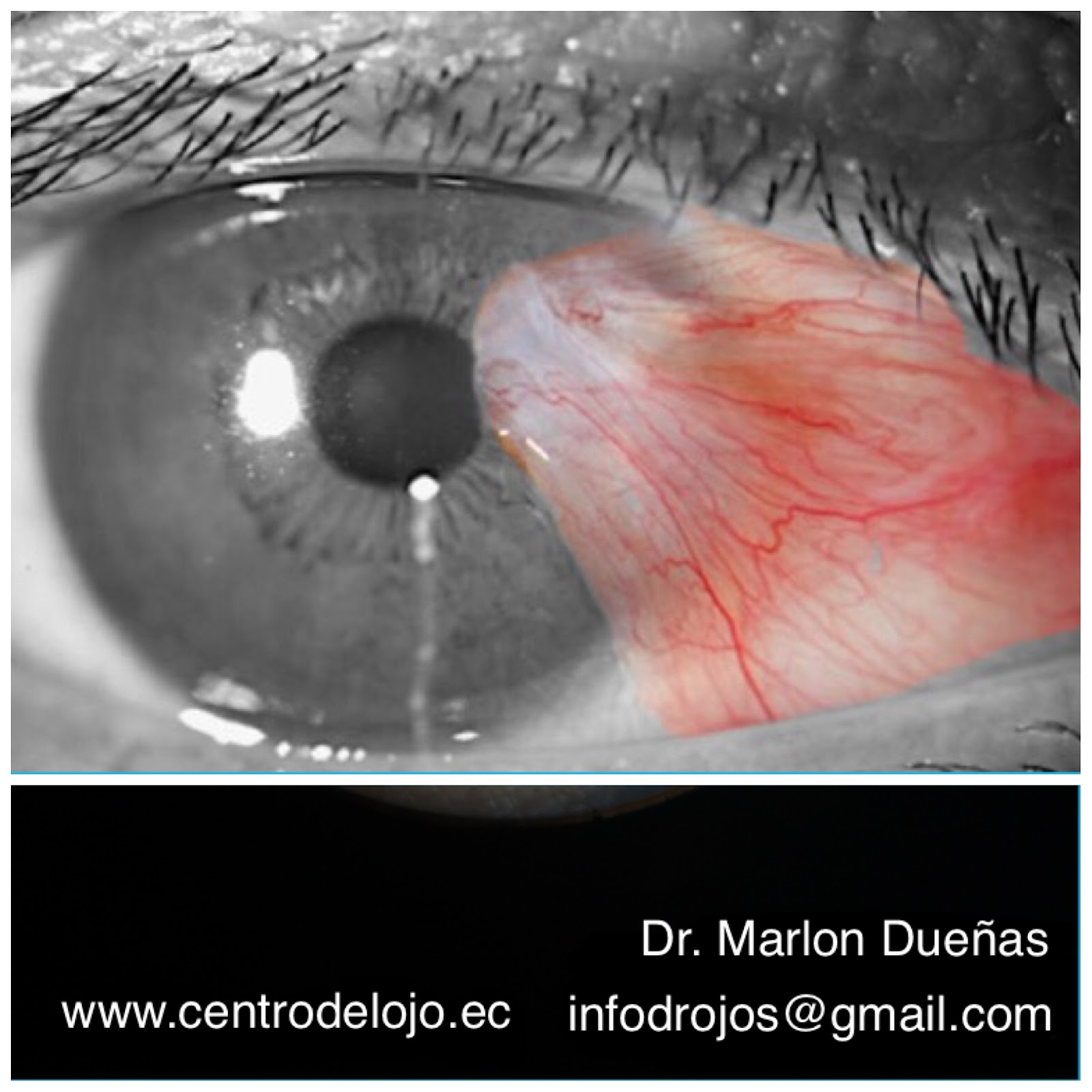 Blog del Oftalmólogo en Guayaquil