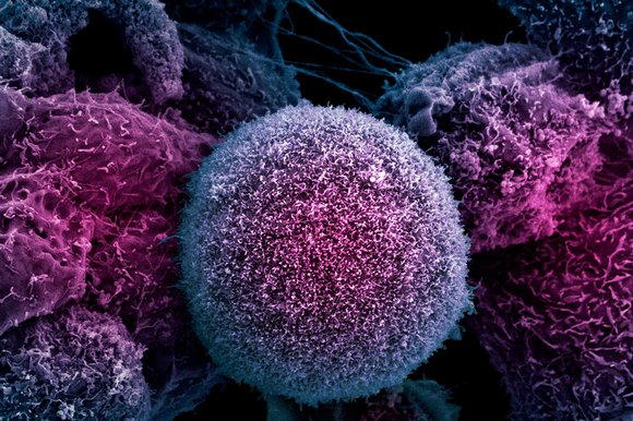 Cáncer En La Piel: Definición Del Cáncer