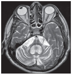 Hot Cross Bun Sign & Hot cross bun appearance of skull | AcrossPG Blog!