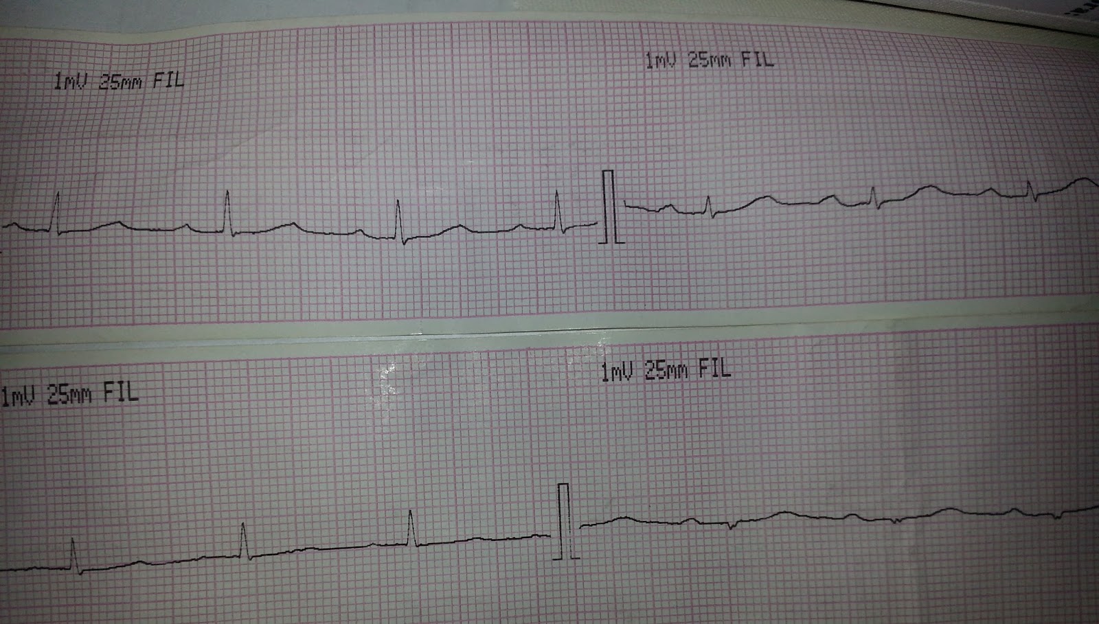Electrocardiograma: Caso clínico 'Stop'