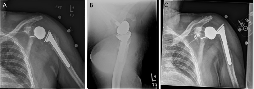 UW Shoulder and Elbow Academy: Reverse total shoulder failure from ...