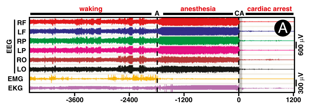 The Neurocritic: End of Life Gamma Waves: Altered State of ...