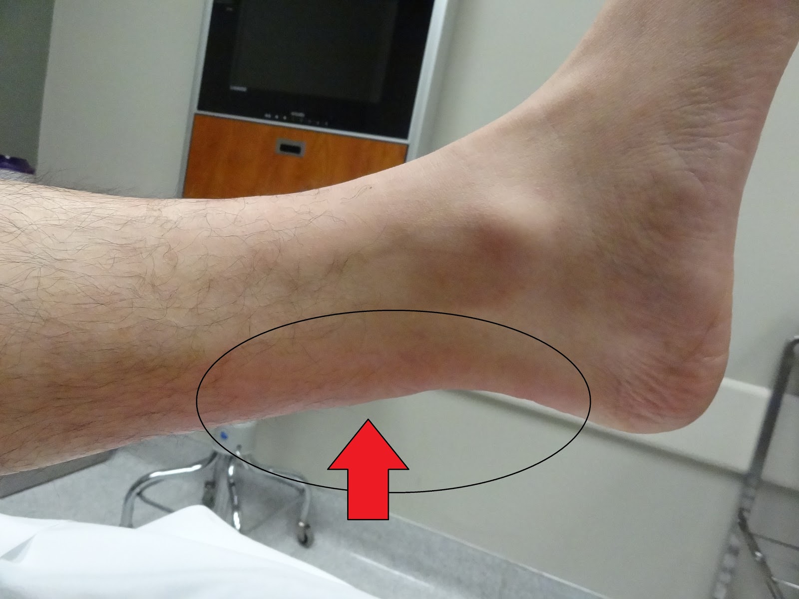 Run Lily Run Ruptured Achilles Tendon The Beginning Run Lily Run Ruptured Achilles Tendon The Beginning