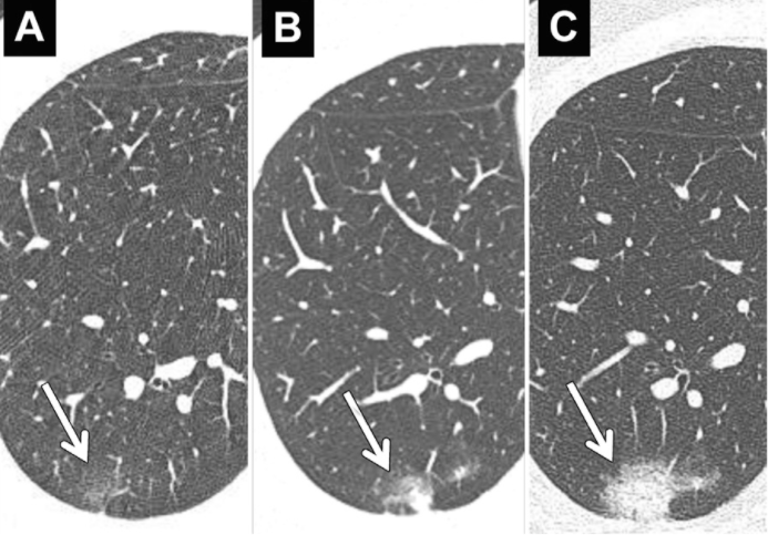 Un nodul pe plămân este cancer? - Medstory