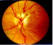 Neuritis Optik | Health Care