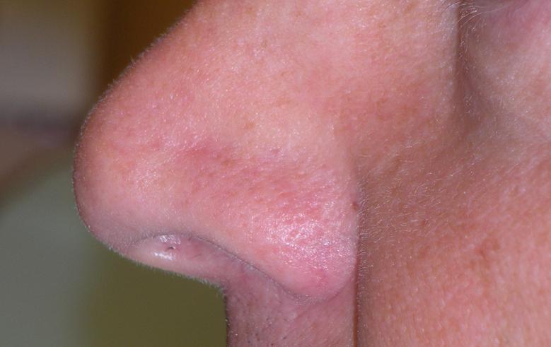 Basal Cell Carcinoma Cancer On My Nose Mohs Surgery Basal Cell Carcinoma Cancer On My Nose