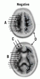 Nuclear Medicine Technology Program: Amyvid - Flobetapir F 18