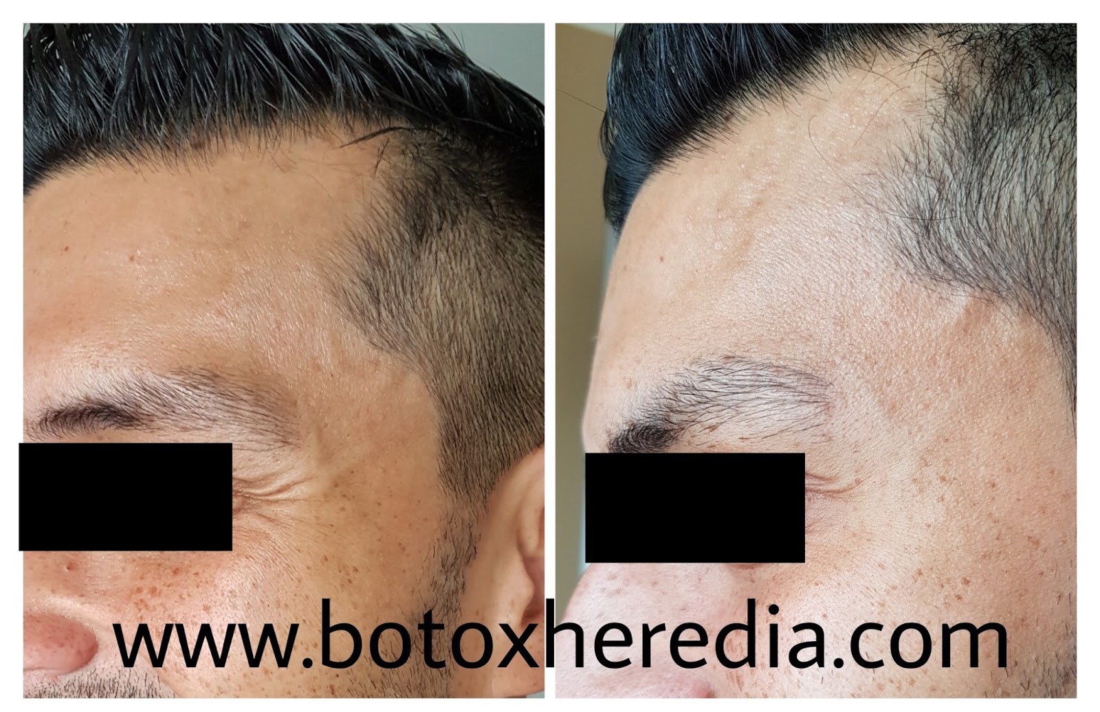Botox, Acido Hialurónico, Bichectomia, Invisible Touch Hilos Pdo