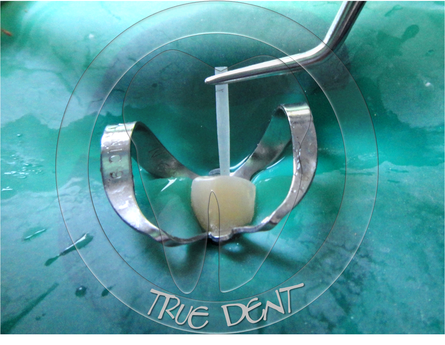 TRUEDENT: ESPIGO DE FIBRA DE VIDRIO