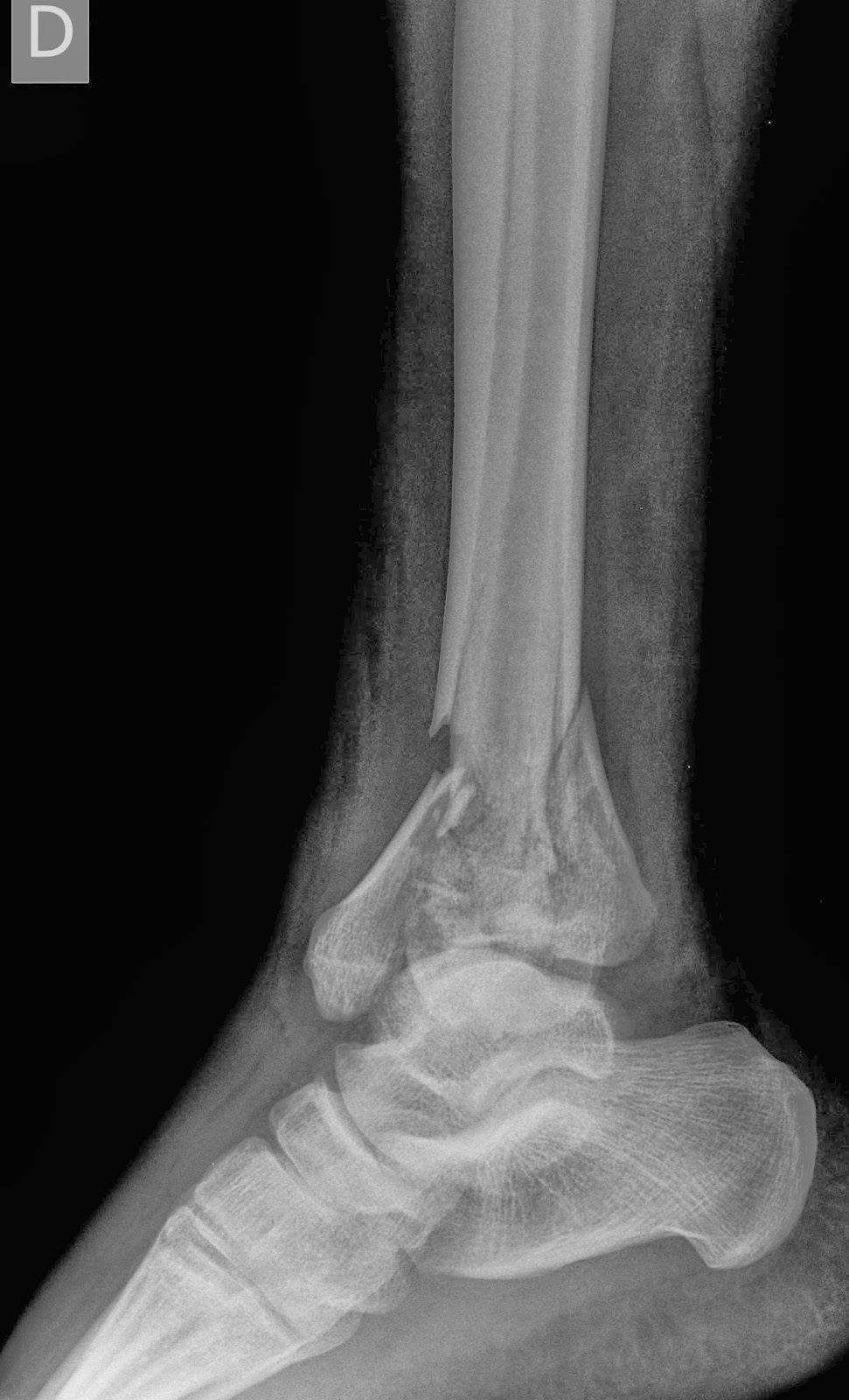 Fractura Pilao tibial e maleolo lateral dto + Fractura maleolo medial ...