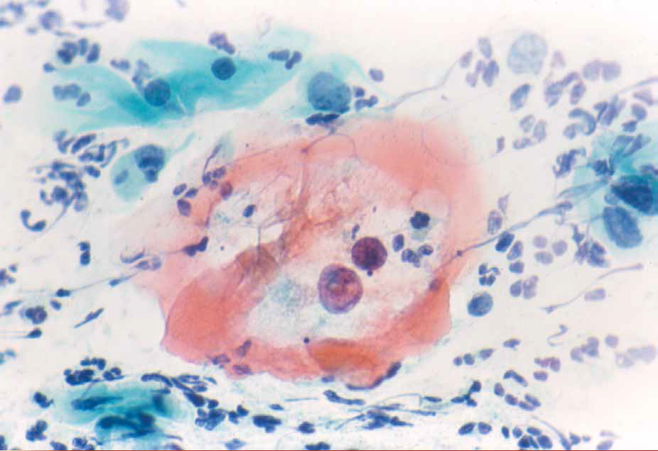 Histopatología: PATOLOGIA GINECOLOGICA