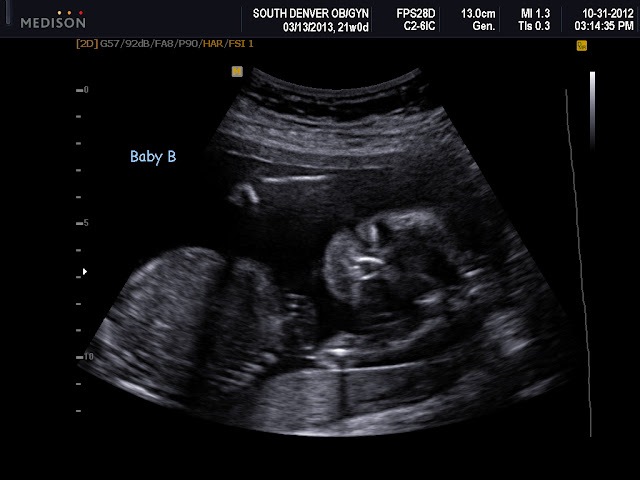 A Road Well Traveled: Anatomy Scan- 21 weeks!