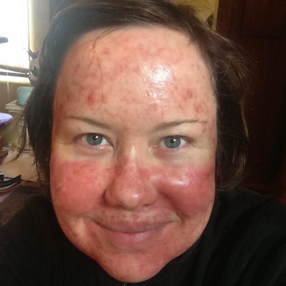 Efudex (Fluorouracil) Adventure