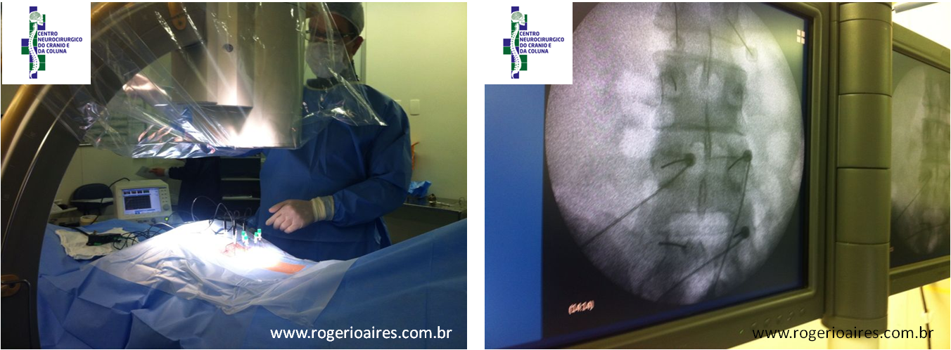Dr Rogério Aires: RIZOTOMIA PERCUTÂNEA POR RADIOFREQUÊNCIA - TRATAMENTO ...