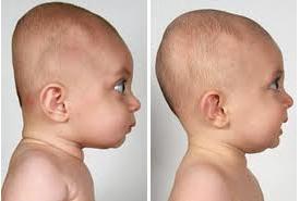 New Born Baby: Flat Head Syndrome
