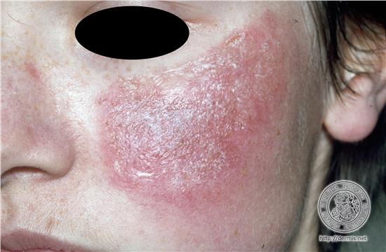 Dermatitis seborreica