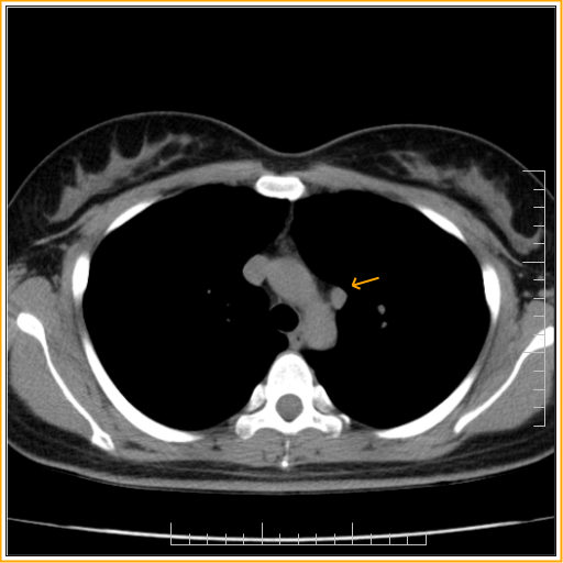 Partial Anomalous Left Upper Lobe Pulmonary Venous Drainage - Radiology ...