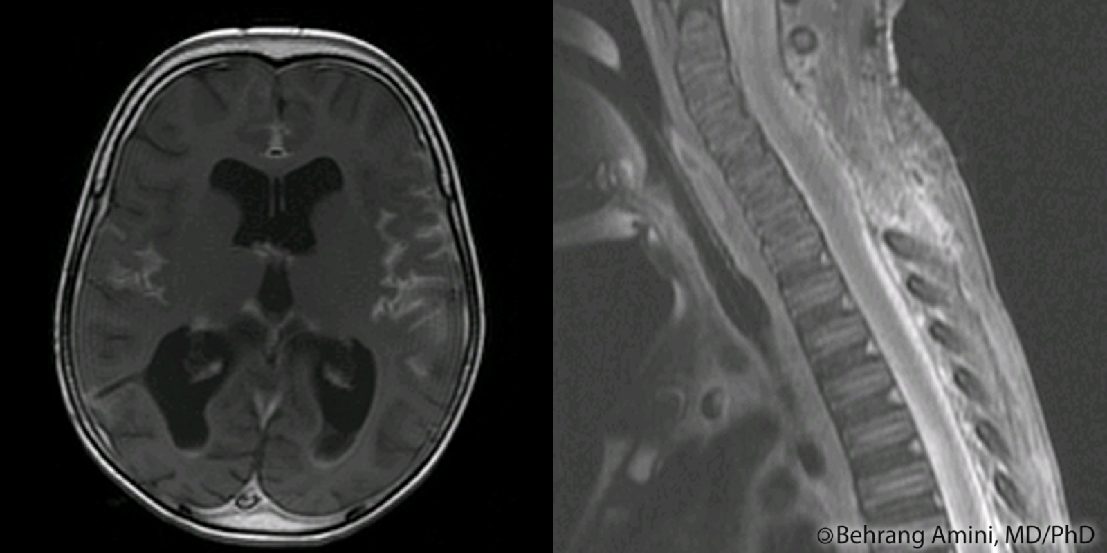 Roentgen Ray Reader: Neurocutaneous Melanosis