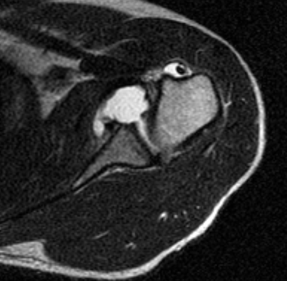 Recurrent Dislocation Shoulder- MRI - Sumer's Radiology Blog