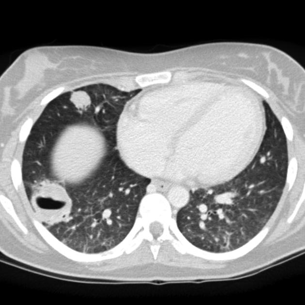Radiology Pearls: D.D.of pulmonary cavitary lesions